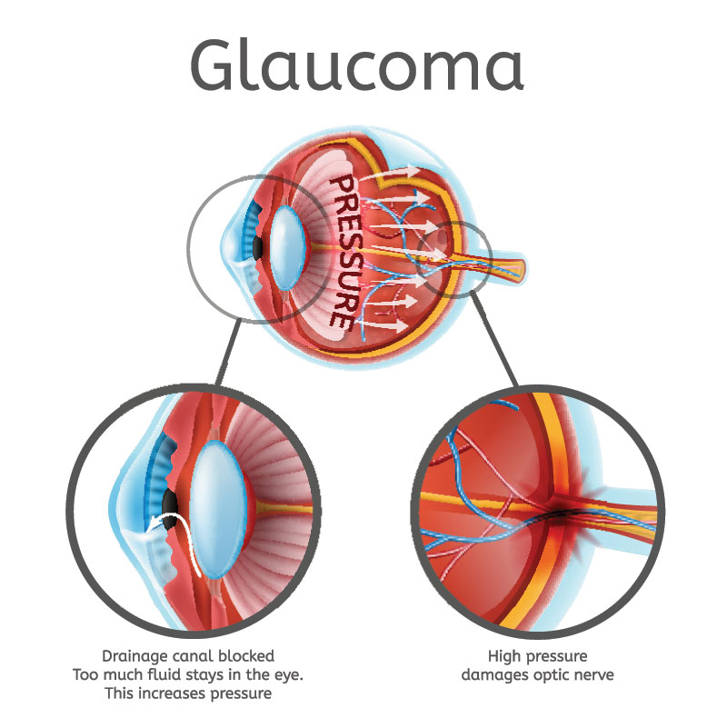 Glaucoma – Vancouver Coastal Eye Surgeons